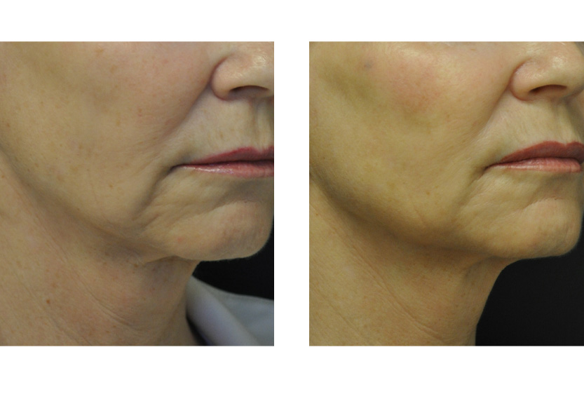 Ultherapy | Skin tightening in San Diego CA