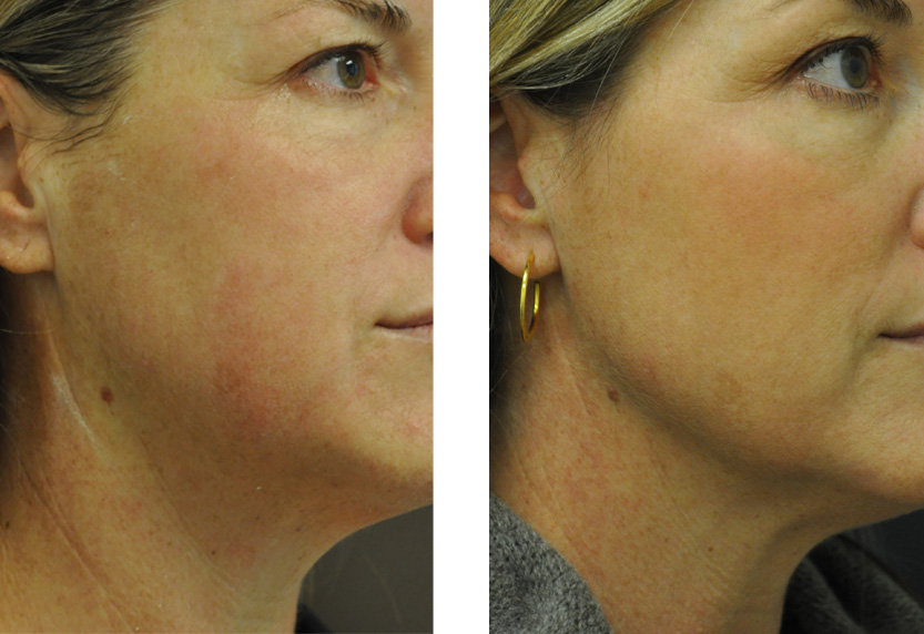 Ultherapy | Skin tightening in San Diego CA
